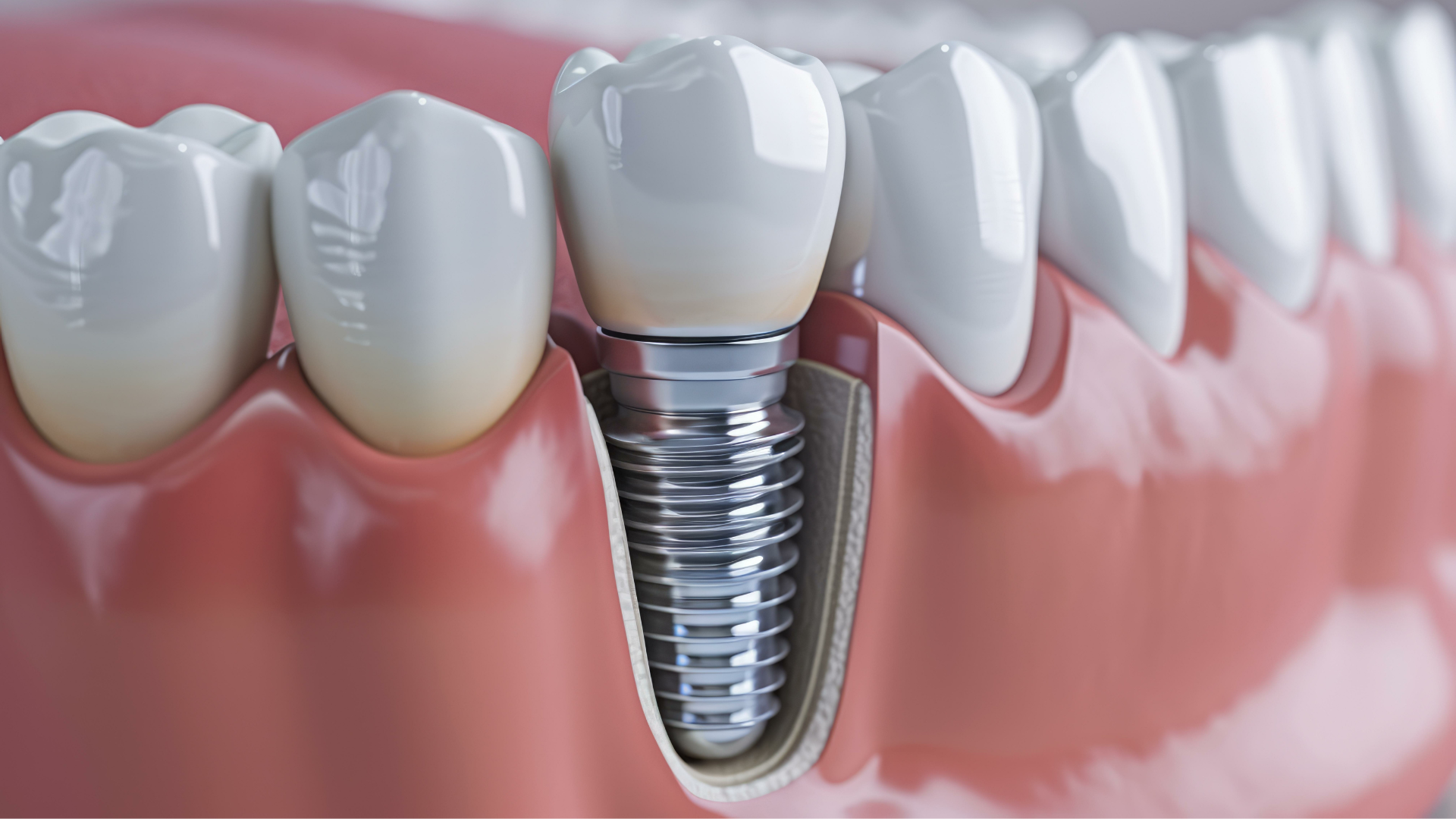 Why cutting is suitable for manufacturing implants｜Explanation of ...